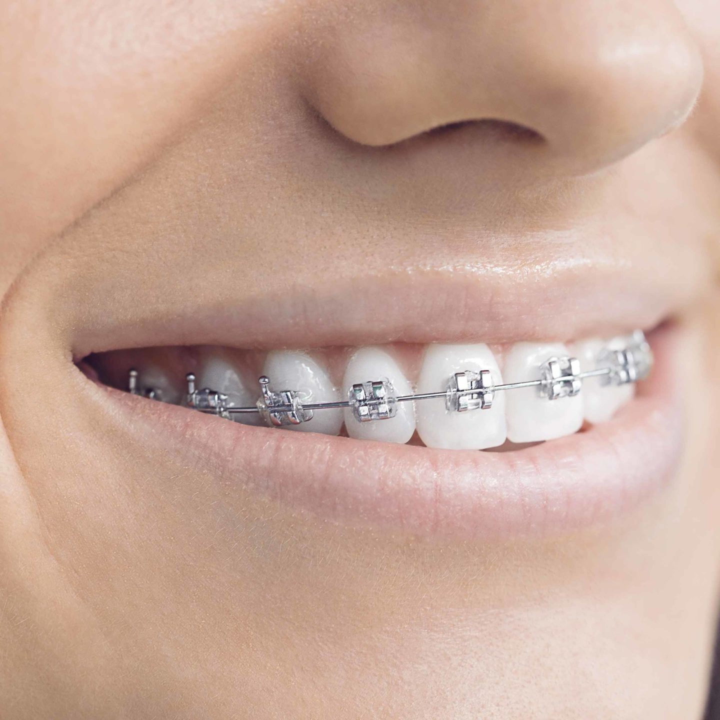 Les types de broches en orthodontie | Orthoville